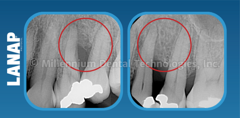 LANAP® - Millennium Dental Technologies, Inc.