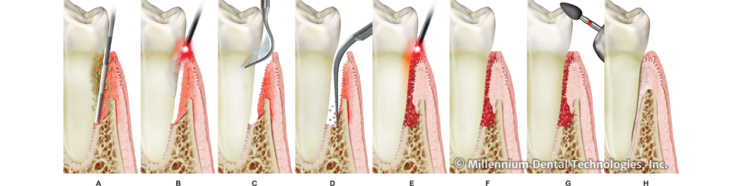 LANAP® - Millennium Dental Technologies, Inc.